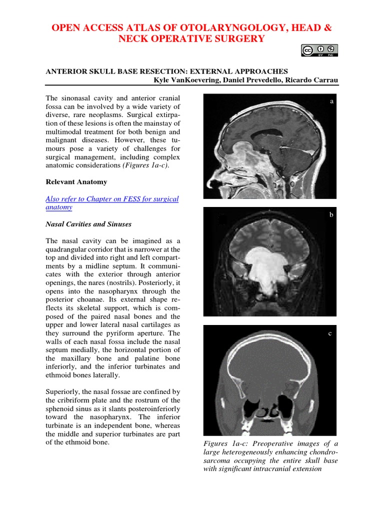 Anterior Skull Base Resection External Approaches | Download Free PDF ...