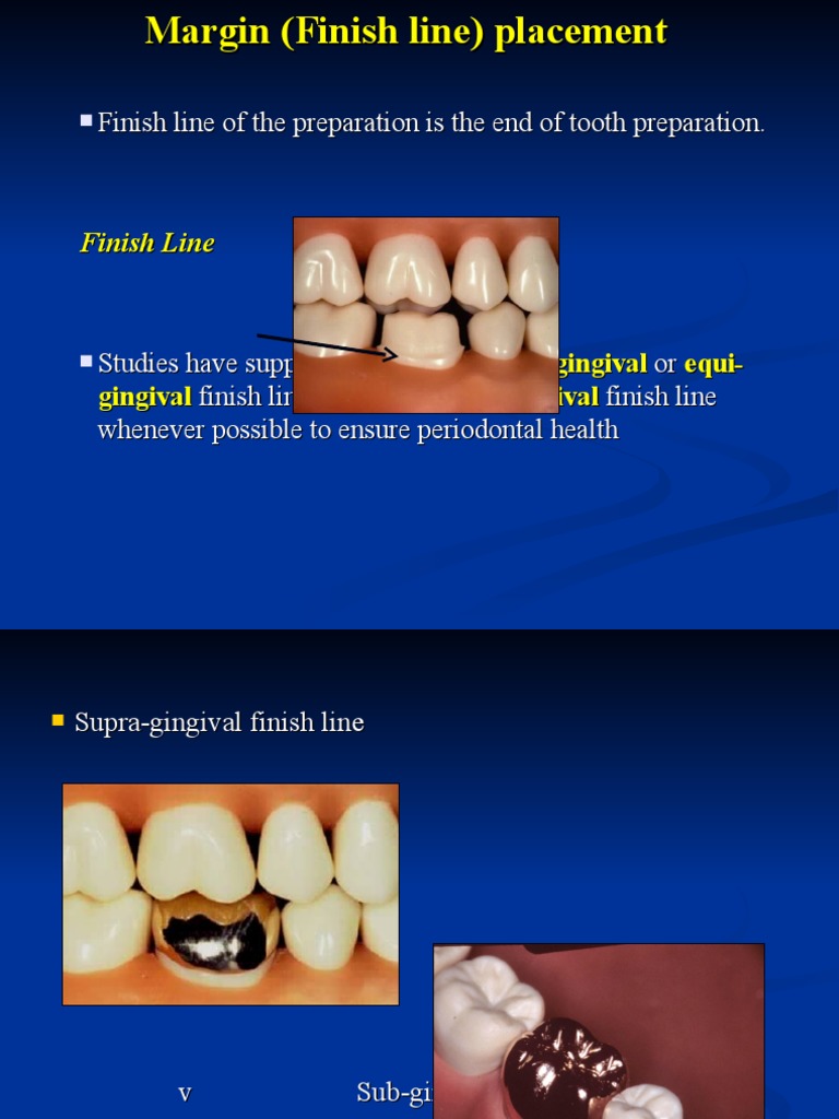 Types of Finish Lines in Tooth Prep | PDF | Dentistry Branches ...