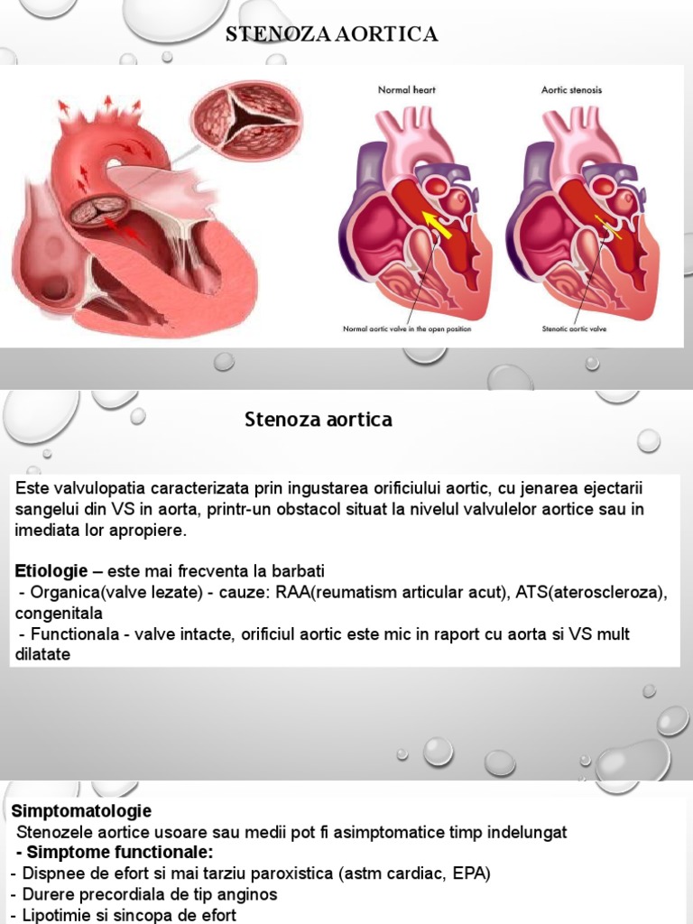 Stenoza Aortica | PDF