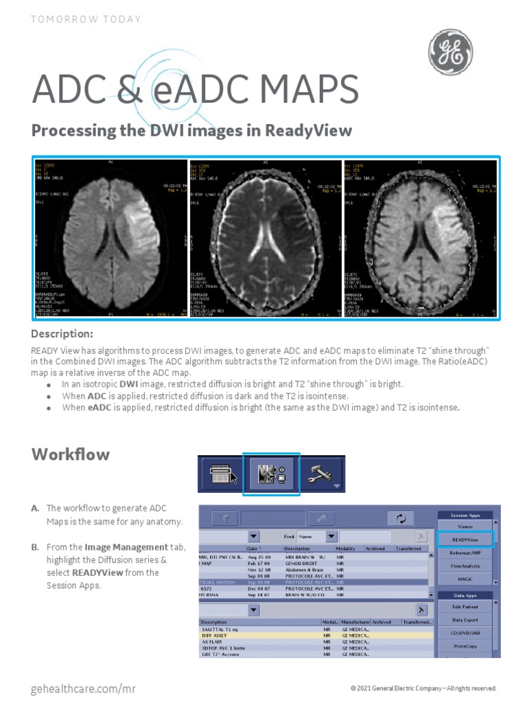 Adc & Eadc Maps: Processing The Dwi Images in Readyview | PDF | Analog ...