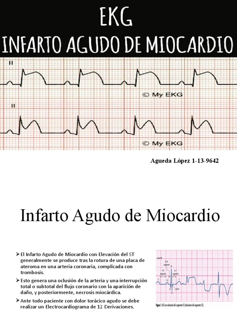 Infarto Agudo de Miocardio: Diagnóstico y Fases | PDF | Infarto de ...