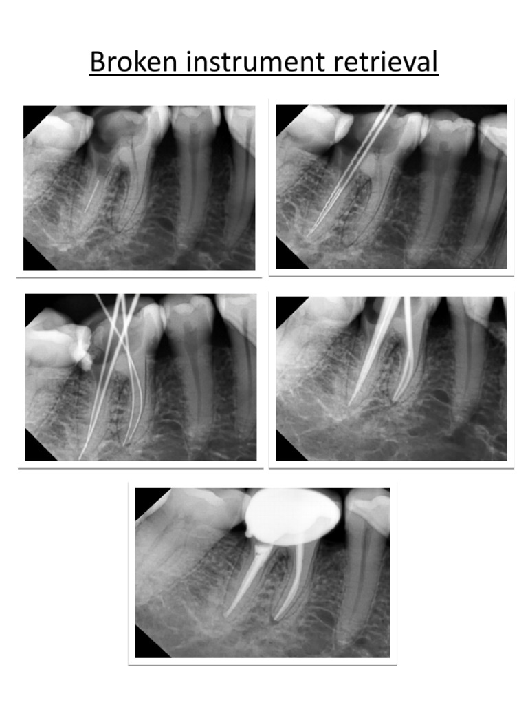 Broken Instrument Retrieval Guide | PDF