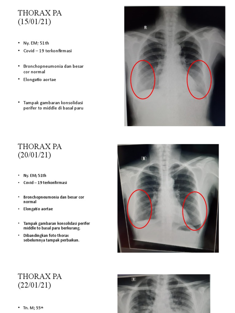 Perbandingan Hasil Rontgen Thorax | PDF