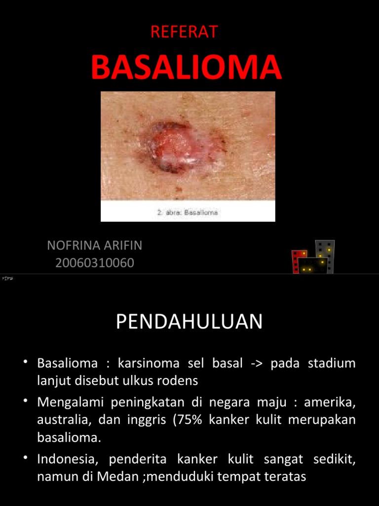 Basalioma | PDF