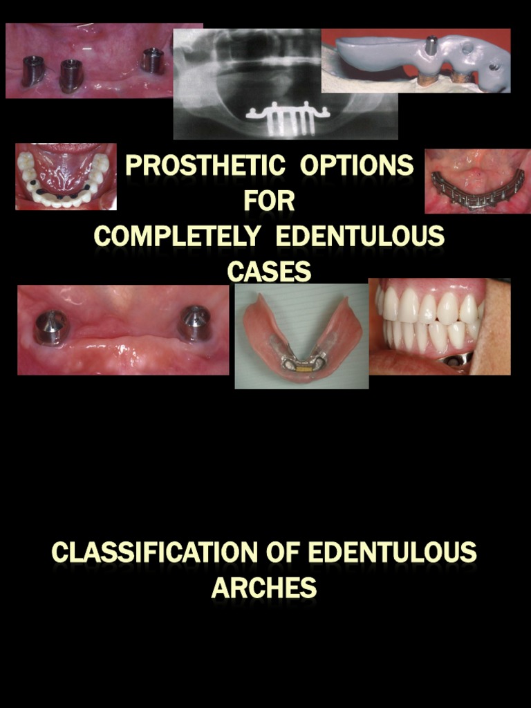 Prosthetic Options For Edentlous Mandible | PDF | Dental Implant | Dentures