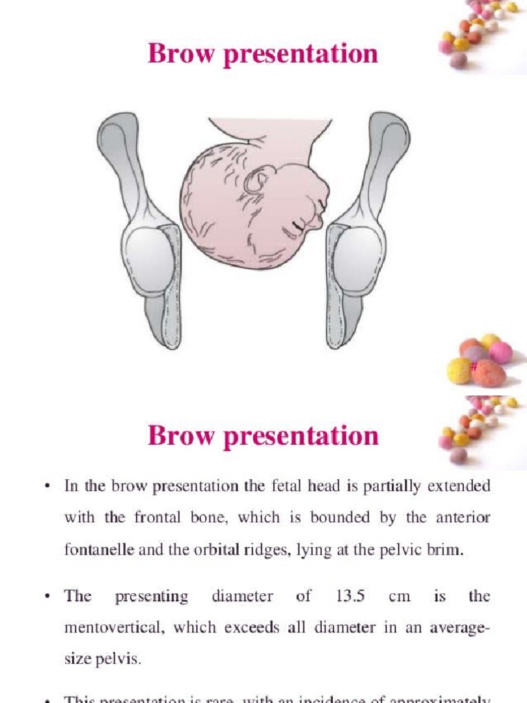 Brow Presentation Diameter