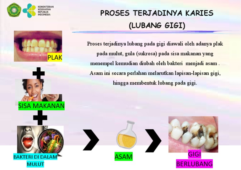 Poster Proses Terjadinya Karies | PDF