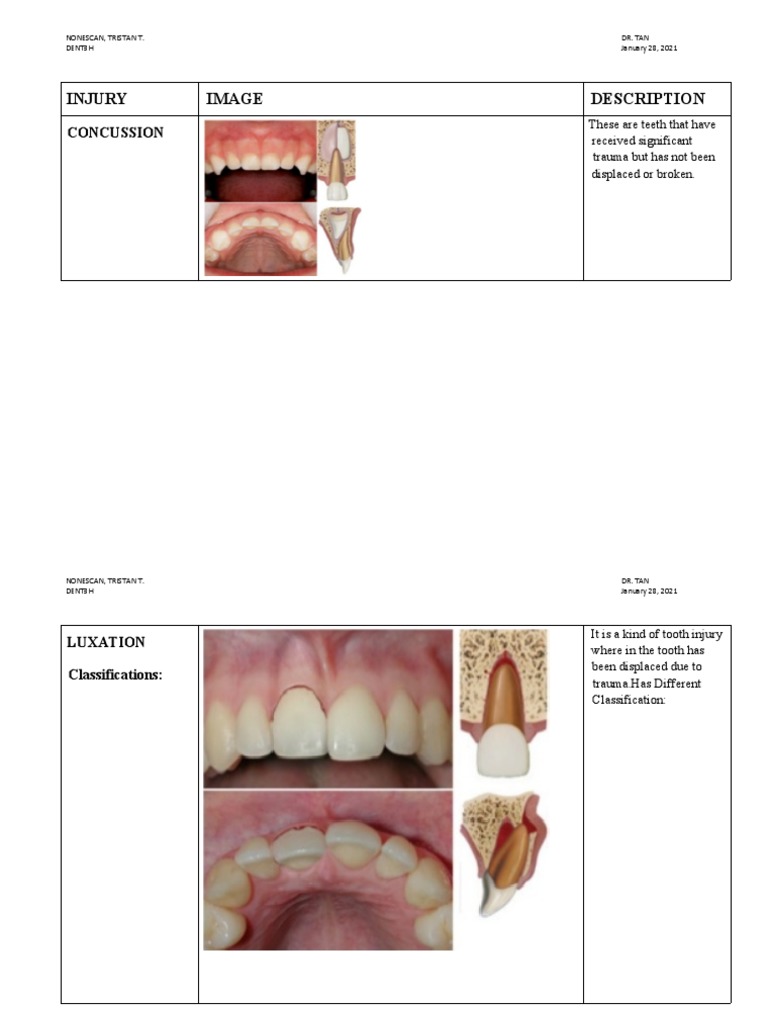 Tooth Concussion