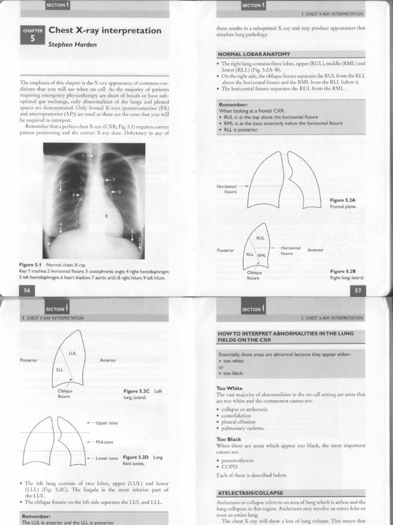 05 Chest X-Ray Interpretation | PDF | Lung | Animal Anatomy