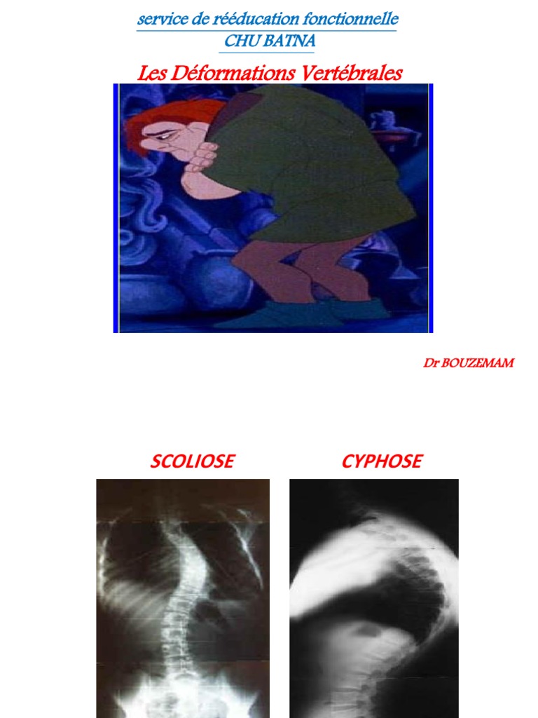 Scoliose et Cyphose : Évaluation et Traitement | PDF | Scoliose ...
