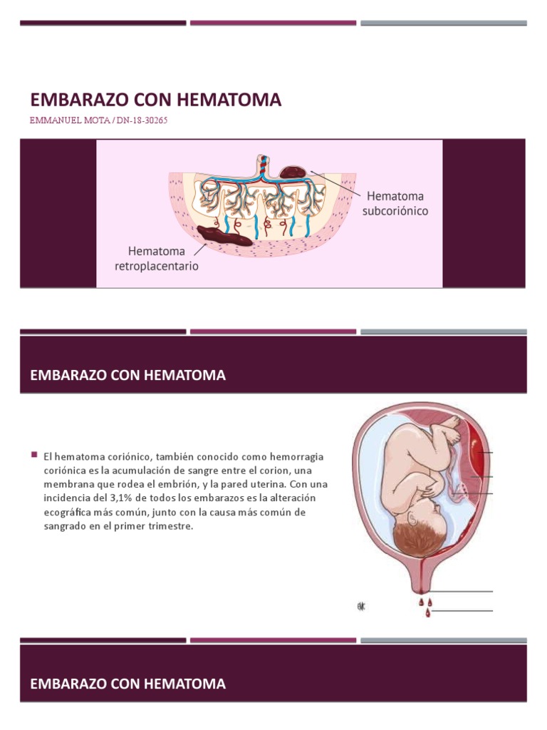 Hematoma Intrauterino | PDF | El embarazo | Placenta
