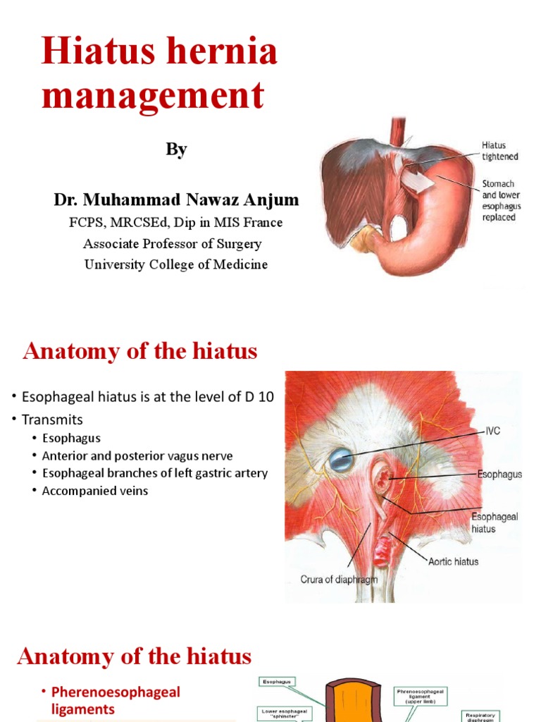 Hiatus Hernia and Their Management | PDF | Esophagus | Gastroesophageal ...