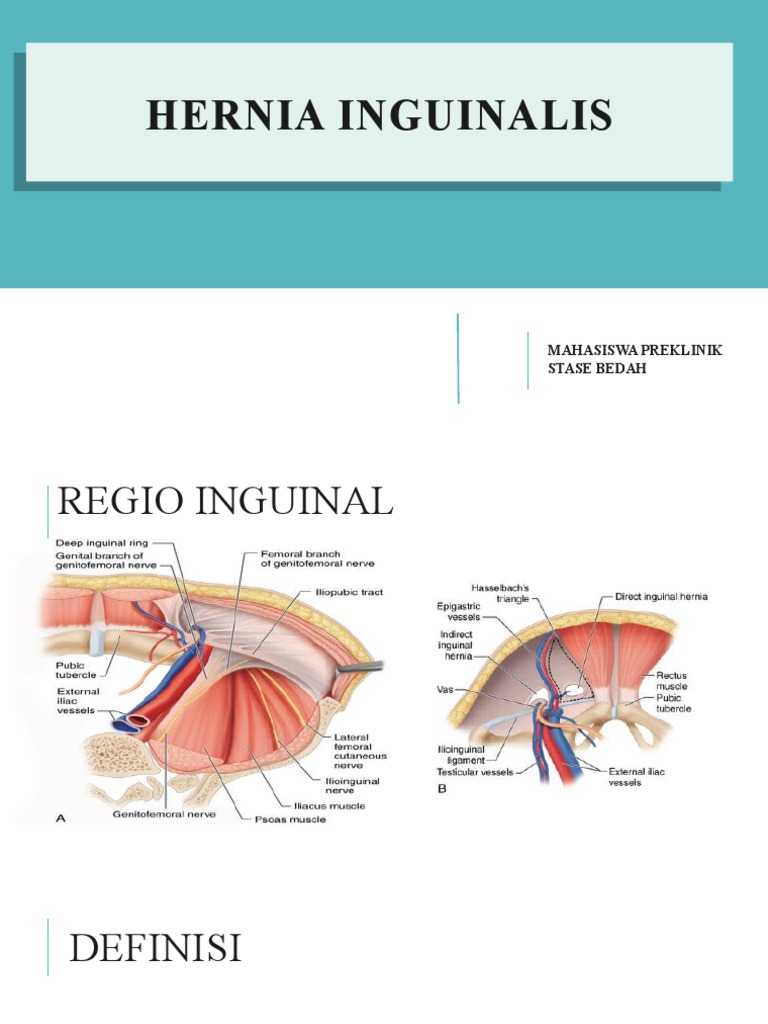 Hernia Inguinalis | PDF