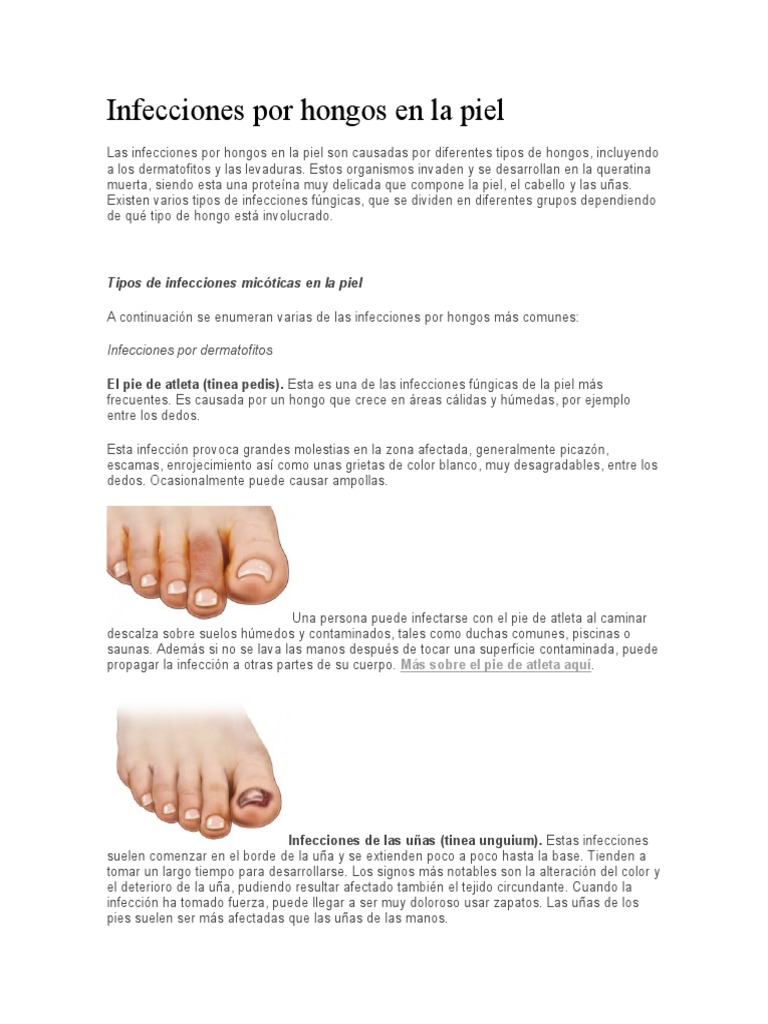 Infecciones Fúngicas en la Piel | PDF | Candidiasis | Clavo (anatomía)