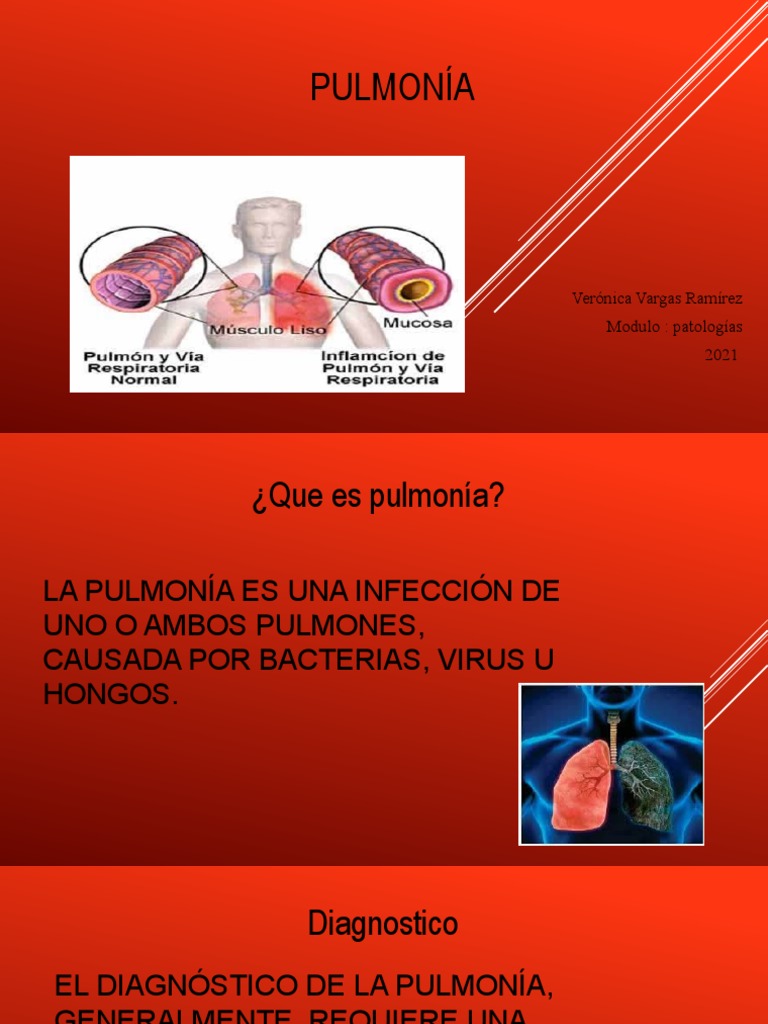 Pulmonía | PDF