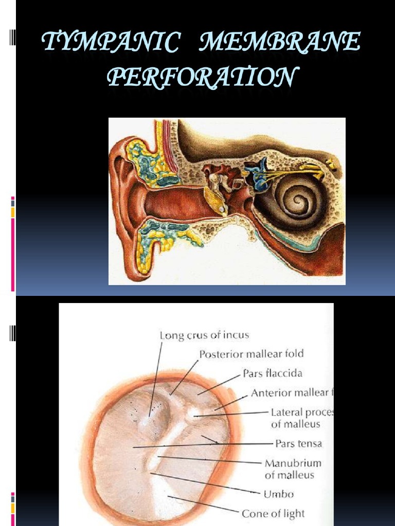 Tympanic Membrane Perforation PDF | PDF