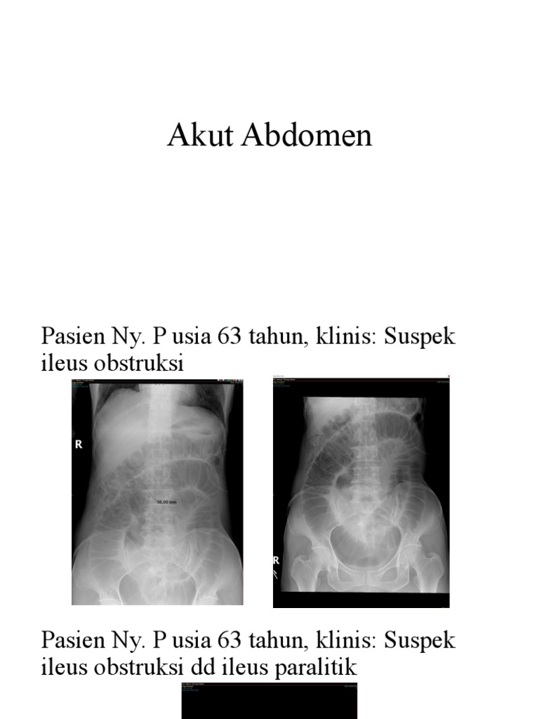 Akut Abdomen | PDF