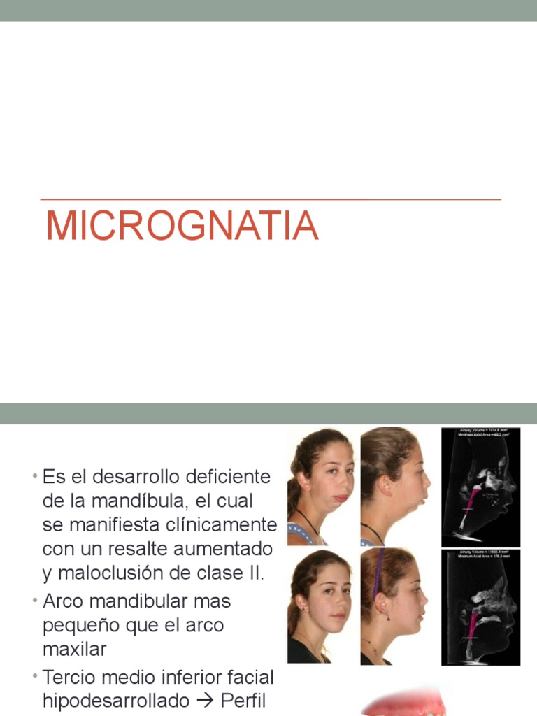 Micrognatia | PDF