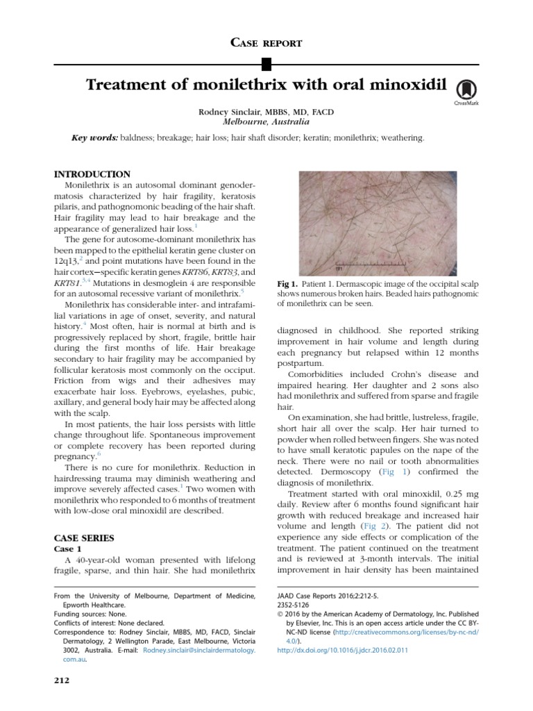 Treatment of Monilethrix With Oral Minoxidil: Ase Report | PDF | Hair ...