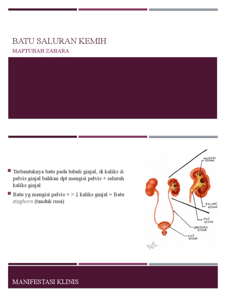 Batu Saluran Kemih | PDF