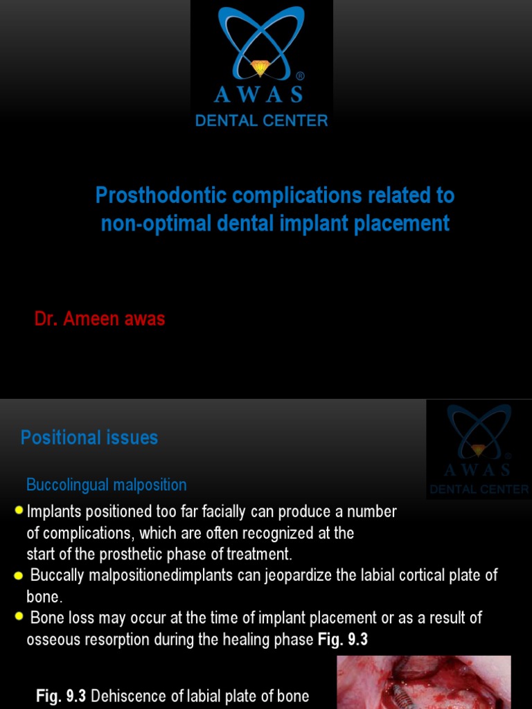Prosthetic Complication of Dental Implants | PDF | Dental Implant ...