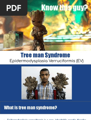 Epidermodysplasia Verruciformis Tree Man