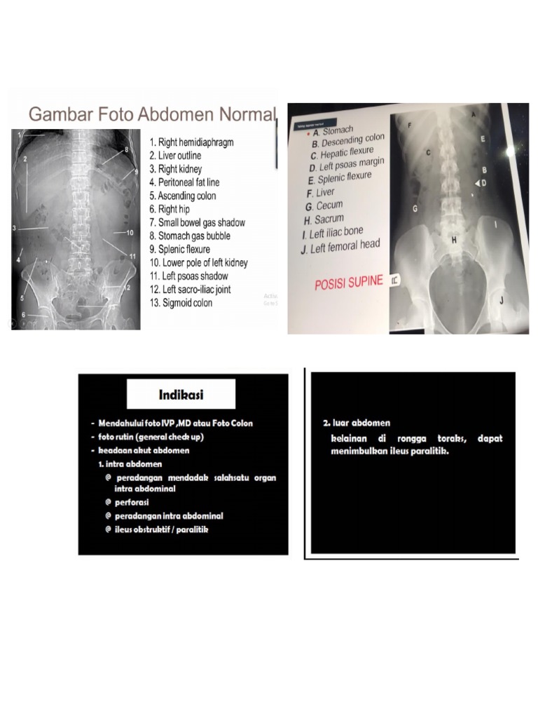 Dasar Dan Cara Pembacaan Foto Polos Abdomen | PDF