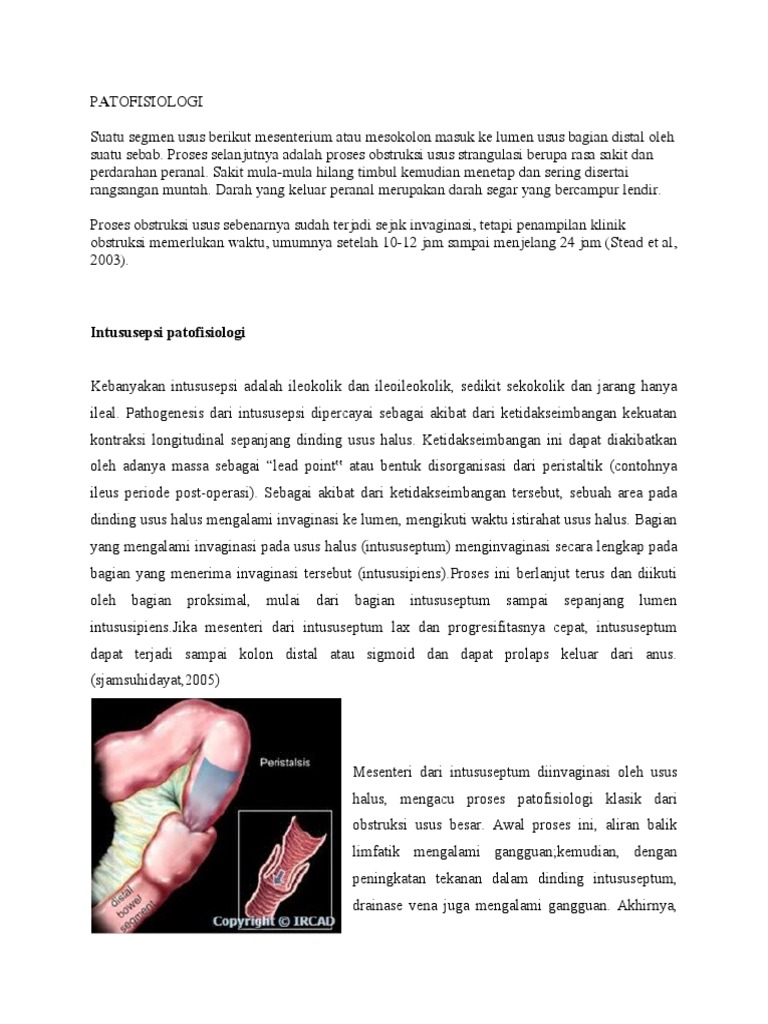 Patofisiologi Intususepsi Usus Halus | PDF