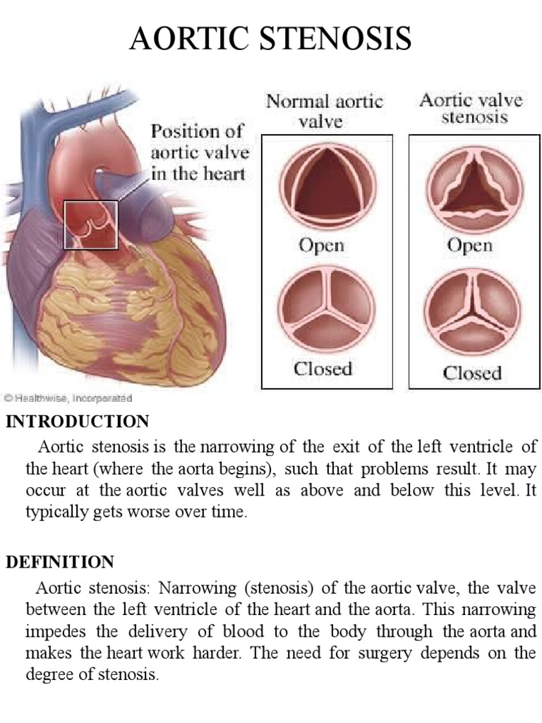 Aortic Stenosis | PDF | Heart Valve | Heart