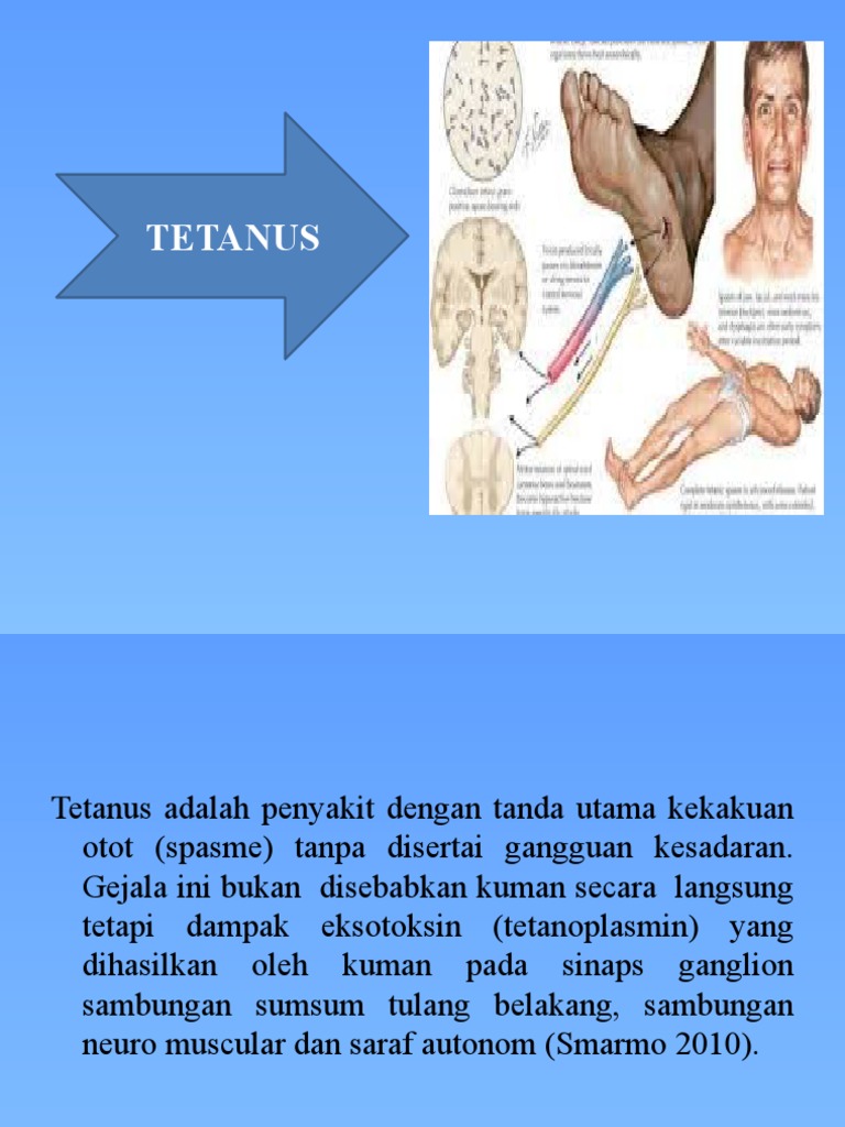 Tetanus | PDF