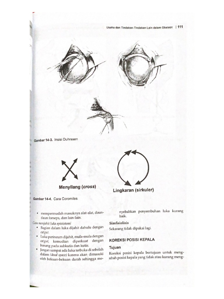 Gambar 14-3. Insisi Duhrssen | PDF