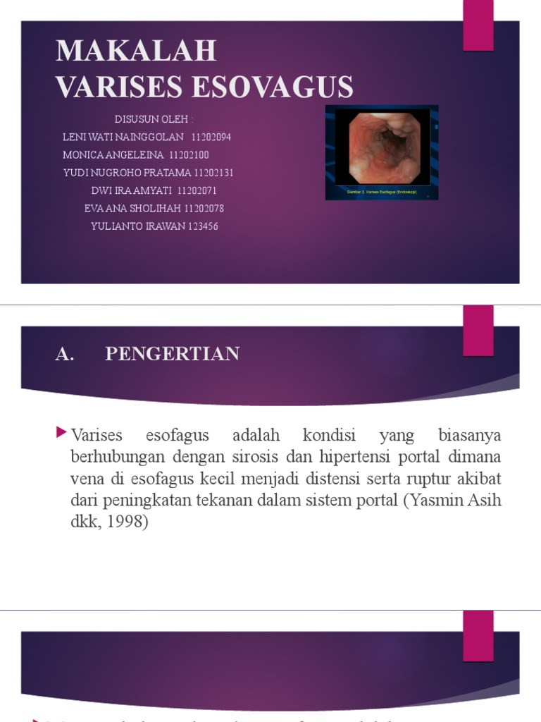VARISES ESOPHAGUS PPT Tgs KMB 2 | PDF