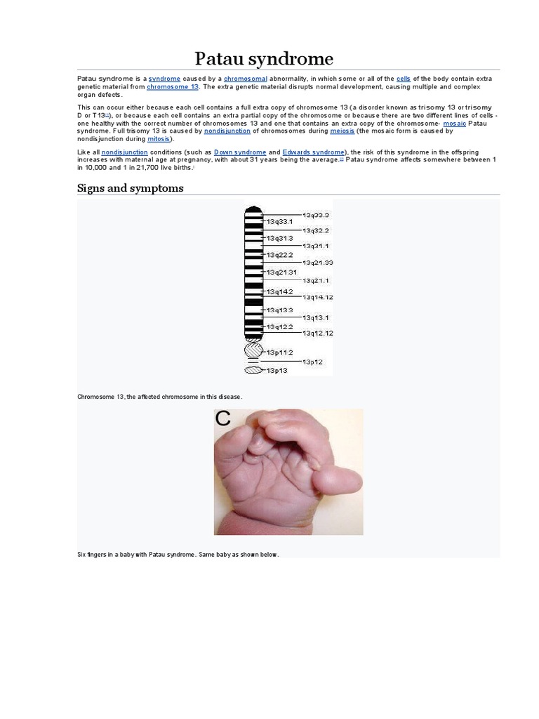 Patau Syndrome: Signs and Symptoms | Download Free PDF | Human Diseases ...