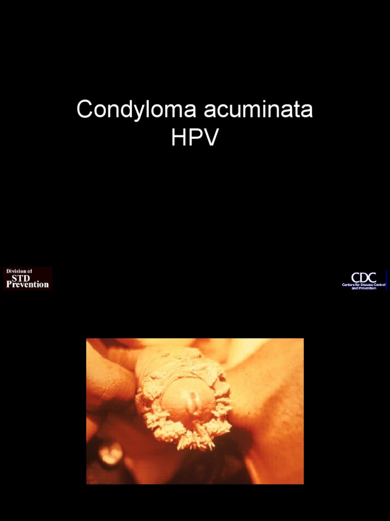 Condyloma Acuminata | PDF | Young Adult