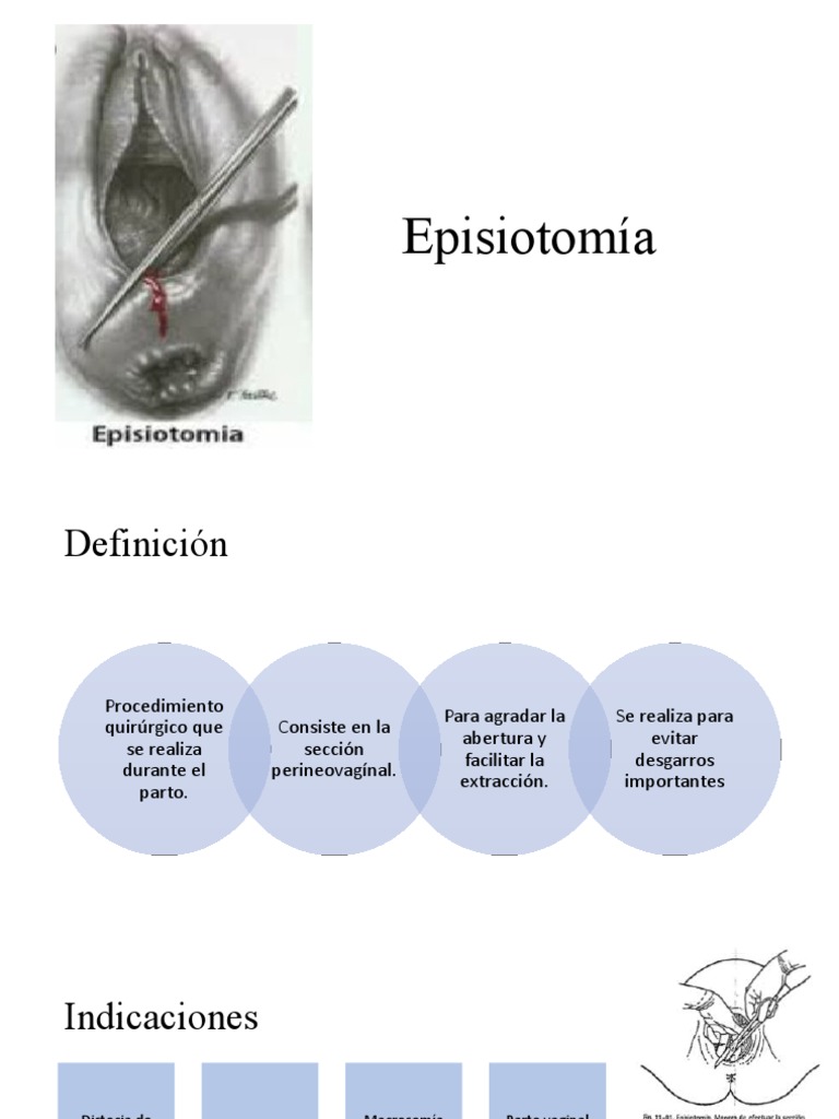 Episiotomía | PDF