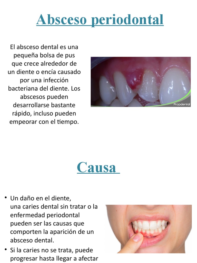 Absceso Periodontal | PDF