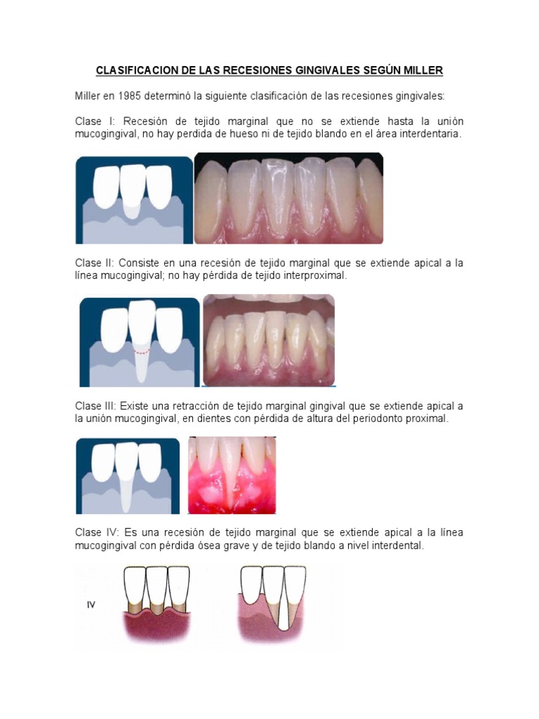 Classifying Gingival Recessions and Dental Mobility According to Miller ...