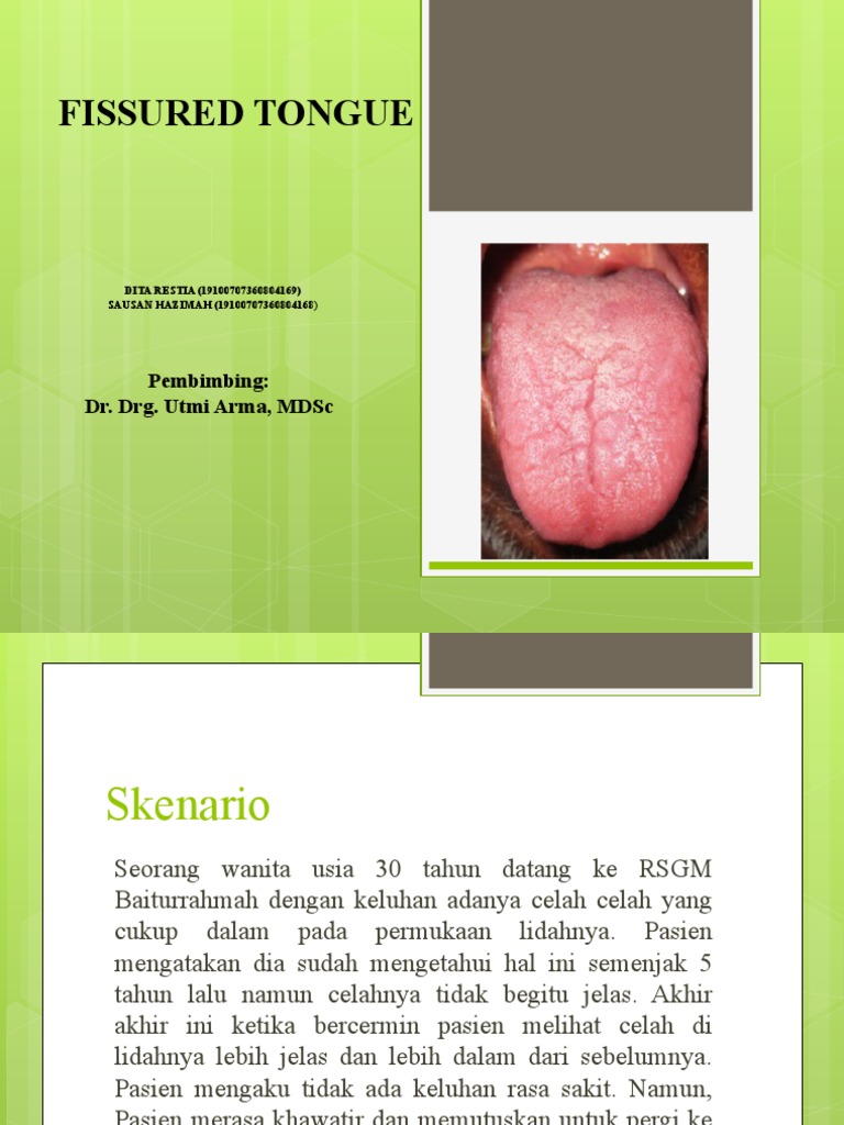 Fissured Tongue | PDF