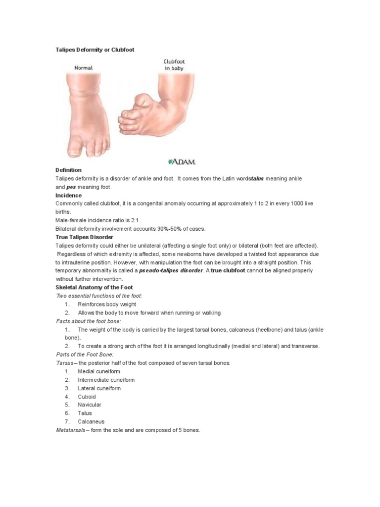 Talipes Deformity or Clubfoot | Foot | Musculoskeletal System