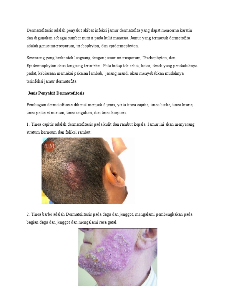 Dermatofitosis | PDF