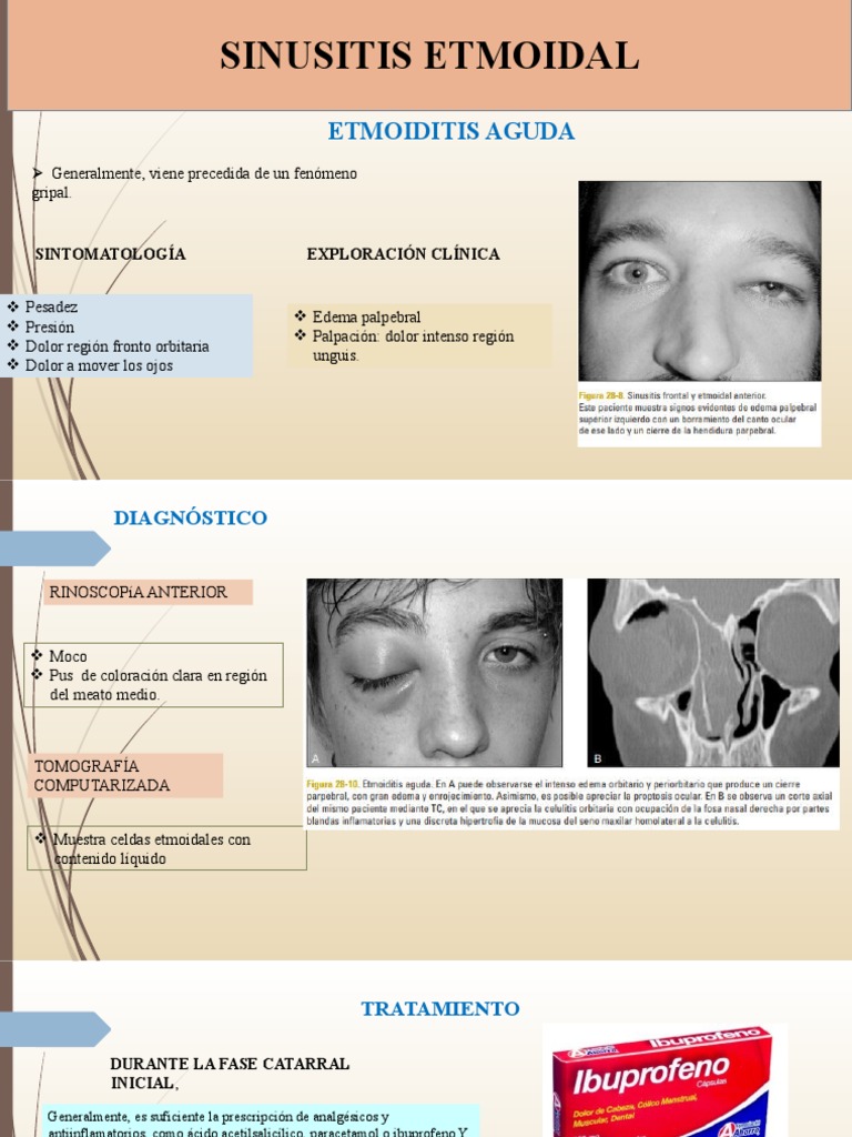 Tratamiento de la Sinusitis Etmoidal | PDF | Dolor de cabeza | Medicina