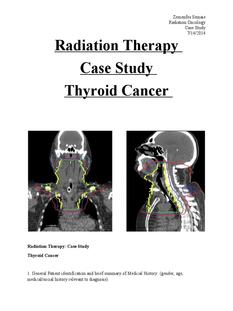Thyroid Cancer Case Study | PDF | Radiation Therapy | Neoplasms