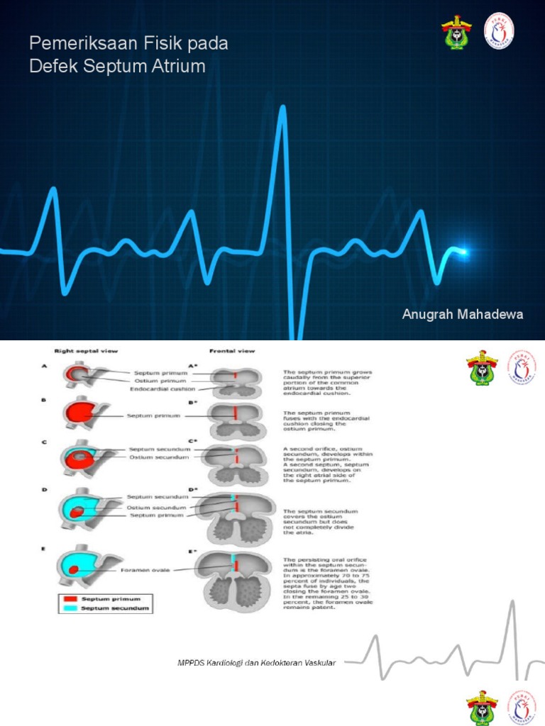 Pemeriksaan Fisik Pada Defek Septum Atrium: Anugrah Mahadewa | PDF