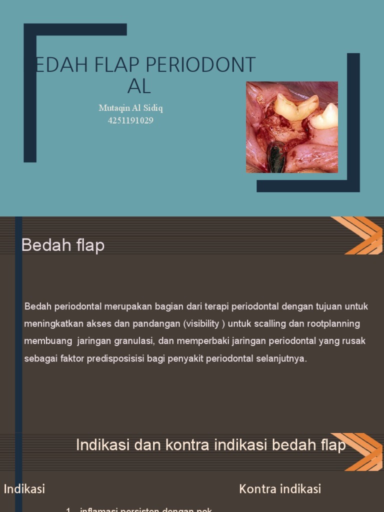Flap Perio | PDF