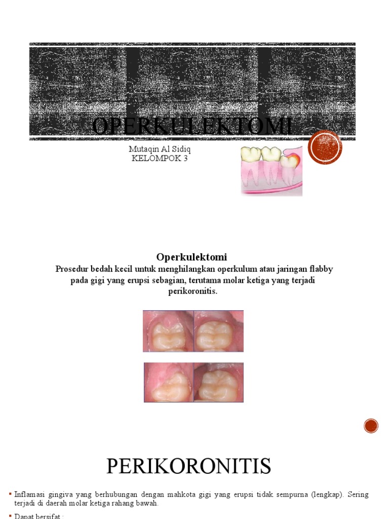 Prosedur dan Indikasi Operkulektomi | PDF