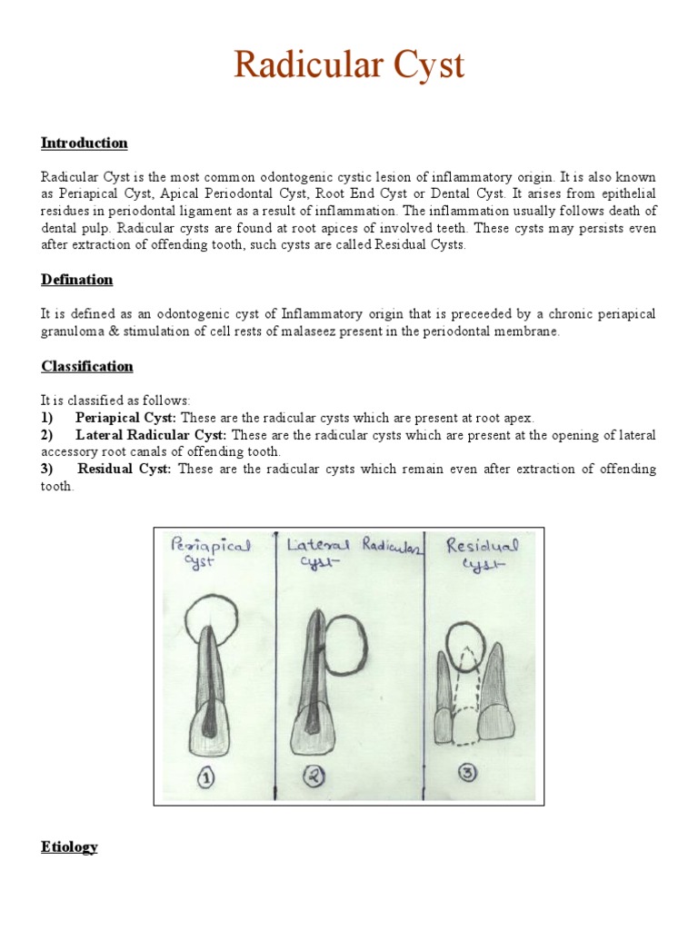 Seminar On Radicular Cyst | PDF | Epithelium | Anatomy
