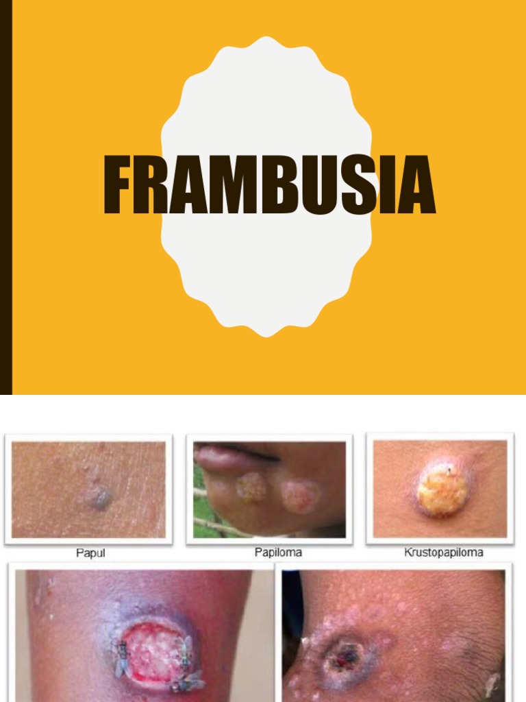 FRAMBUSIA | PDF