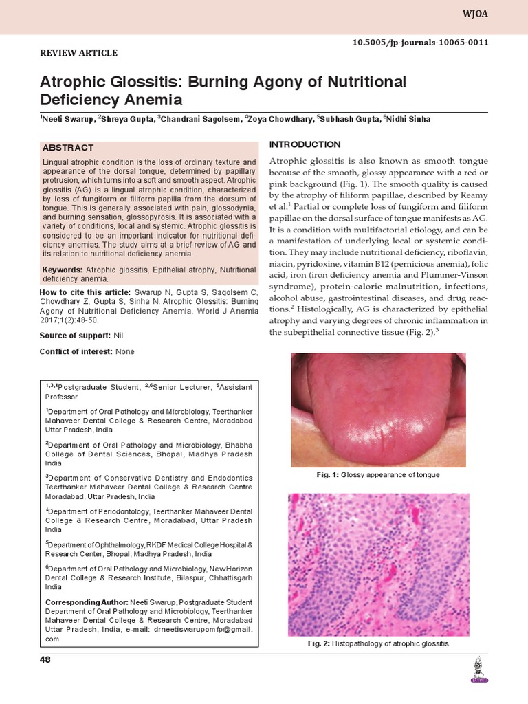 Atrophic Glossitis: Burning Agony of Nutritional Deficiency Anemia ...