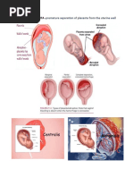 Abruptio Placenta. Final Output | PDF | Placenta | Fetus