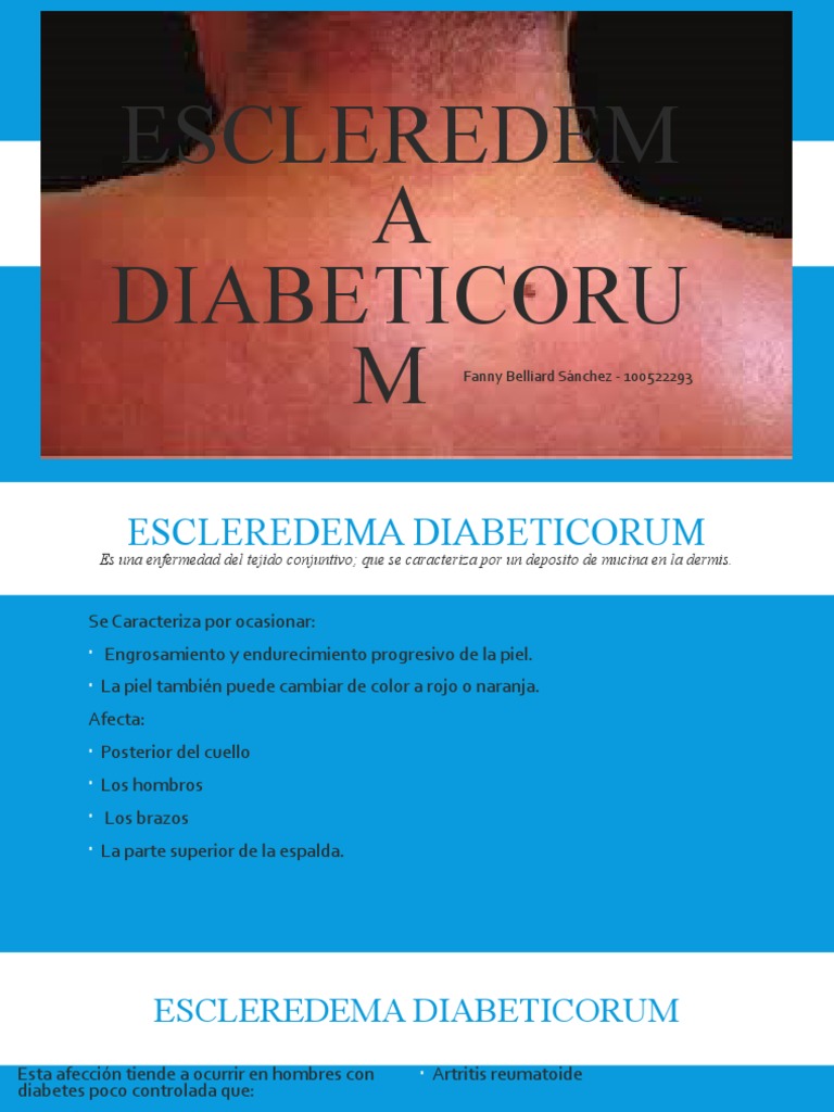 Escleredema Diabeticorum | PDF